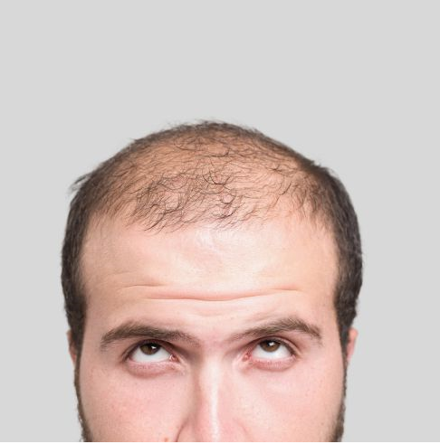 ¿A qué se debe la calvicie?