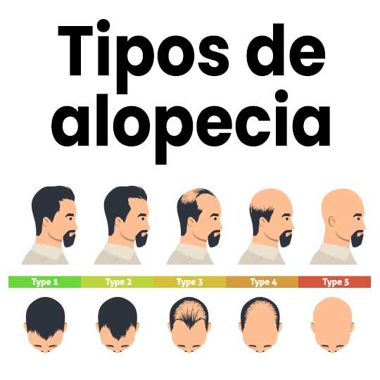 Tipos de alopecia y cómo se trata la calvicie: Lo que debes saber.